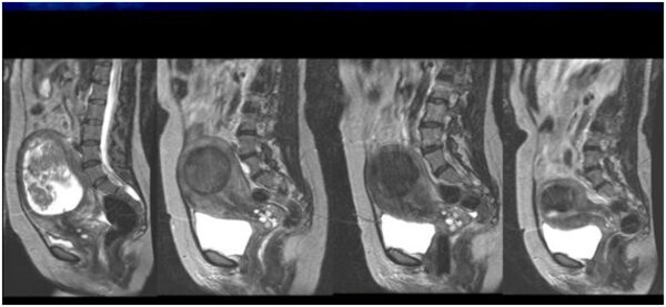 Embolization | Clinton MD | Uterine Fibroids